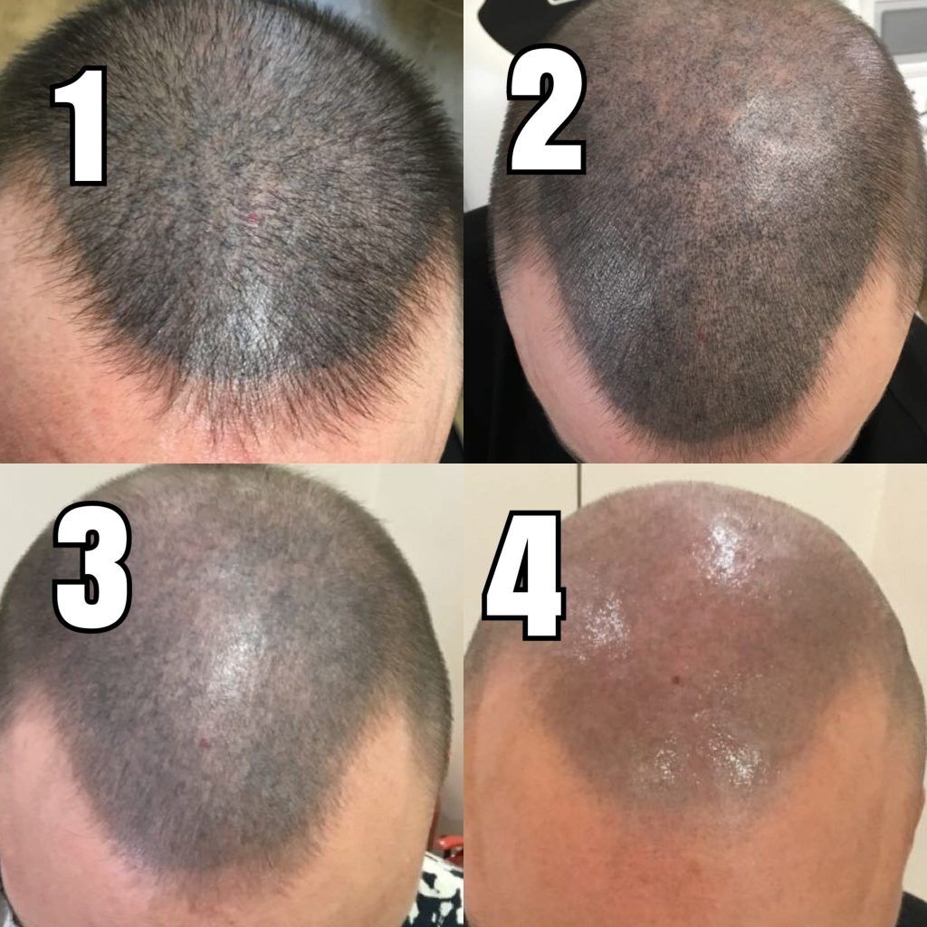 How to fade Scalp Micropigmentation when it's too dark (SMP)