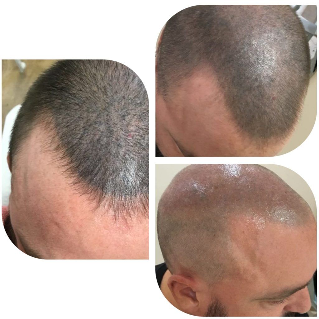 How to fade Scalp Micropigmentation when it's too dark (SMP)